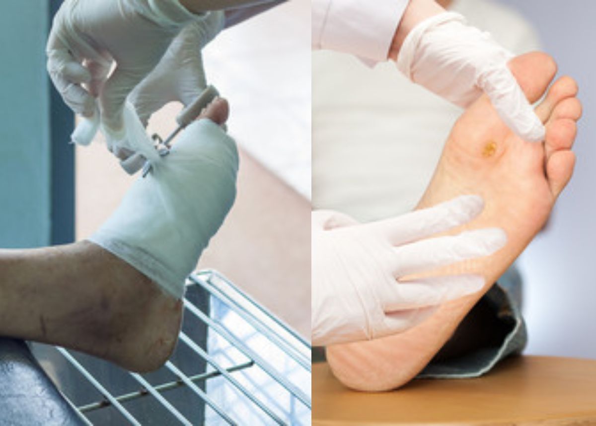 Buruli ulcer: Health authorities warn of flesh-eating disease